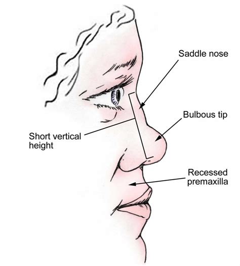 Saddle Nose Deformity Causes Symptoms Diagnosis Treatment And Prognosis