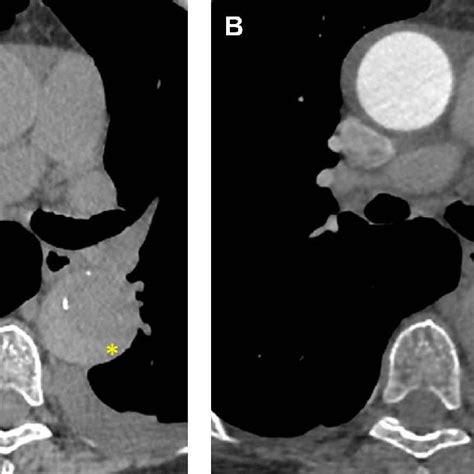 A Ulcer Like Projection In The Descending Aorta Of A Patient With Download Scientific Diagram