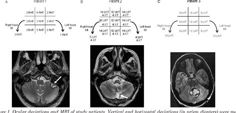 Figure 1 From Cerebellar Skew Deviation And The Torsional Vestibuloocular Reflex Semantic Scholar