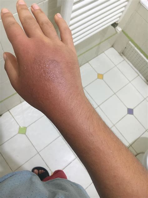 Why My Hands Are Becoming Like This Doctor Didnt Know The Cause R Fibromyalgia