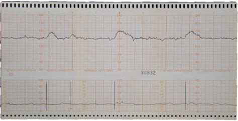 Reactive Non Stress Test