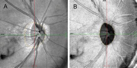 Optic Disc Boundary In Optical Coherence Tomography Oct And Optical Download Scientific