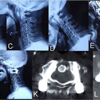 I Atlantoaxial Fracture And Dislocation II Congenital Odontoid Download Scientific Diagram