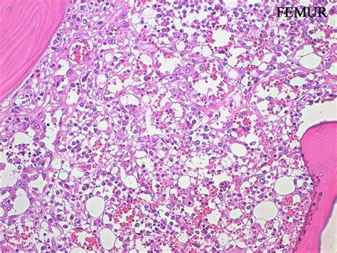 Pathology Outlines Intimal Sarcoma