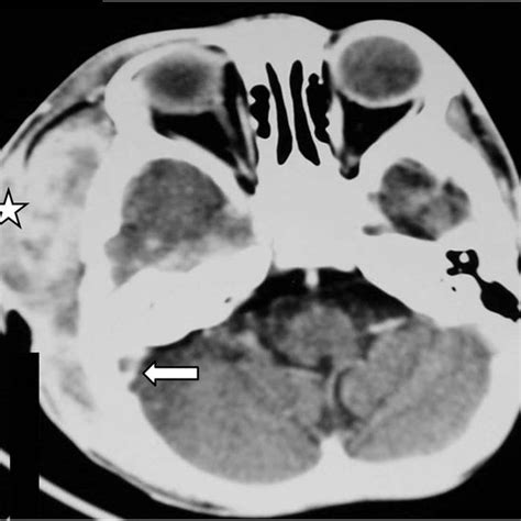 Temporal Bone Ct Axial Slice Tegmen Tympani Lysis With Pneumolabyrinth Download Scientific