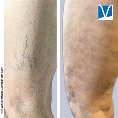 Sudden Blue Veins Why Are My Veins So Blue