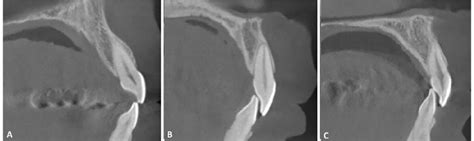 Anterior Overbite Classification A Class I B Class Ii C Class Iii Download Scientific Diagram