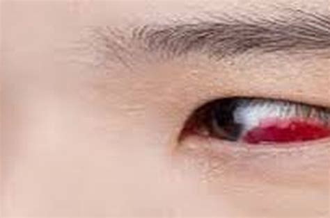 Penyebab Retina Mata Robek Saat Melahirkan Dan Cara Mencegahnya Grid Health