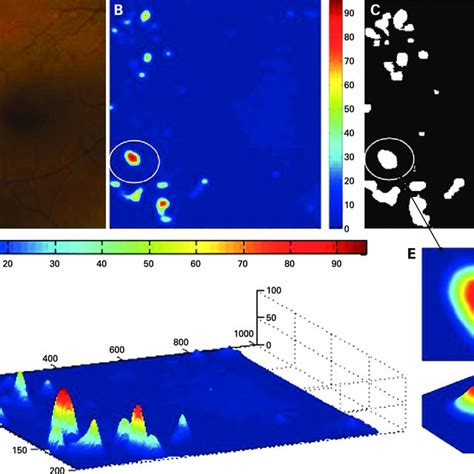 Results Of The Automated Drusen Analysis From Fig 2 A Retinal Area