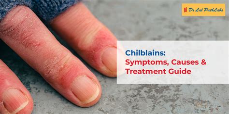 Chilblains Symptoms Causes Types And Diagnosis