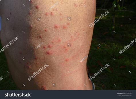 Marks On Bed Bug Bites At Helen Phillips Blog