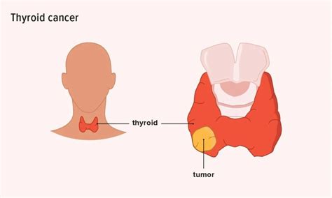 Are Thyroid Nodules Usually Cancerous Fitpaa