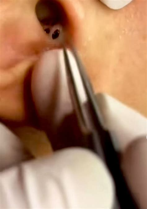 One Of My Top 5 Simply Satisfying Blackhead Removal Rpopping