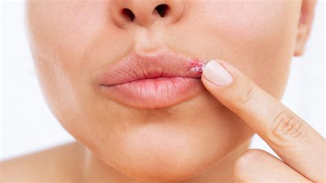 What Does It Mean If Your Bottom Lip Is Itchy