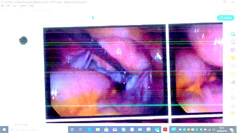 Laparoscopic Sterilisation Faculty Of Medicine