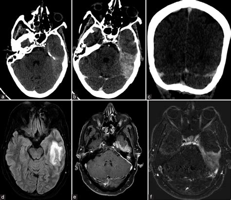 Two Rare Central Nervous System Manifestations Of A Common Disease
