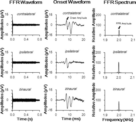 Frequency Following Responses Ffrs And Onset Responses Recorded From