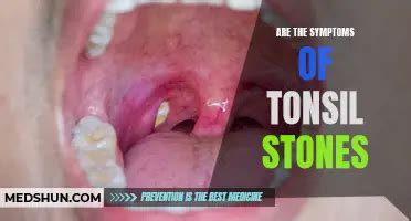 Can White Spots On Your Tonsils Be Tonsil Stones Medshun