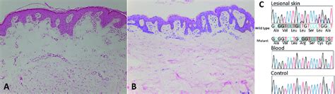 A Skin Biopsy Specimen From The Lower Leg Shows Irregular Acanthosis Download Scientific