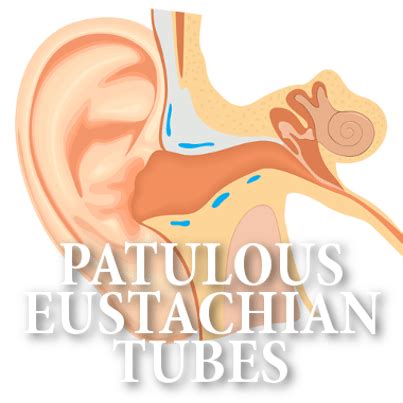 Drs Hearing Loud Echos Of Your Own Voice Patulous Eustachian Tubes
