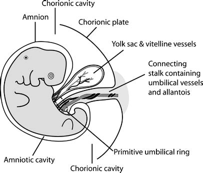 Allantoic Cyst A Prenatal Clue To Patent Urachus Springerlink