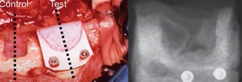 Guided Bone Regeneration Autologous Bone Grafts Part Ii