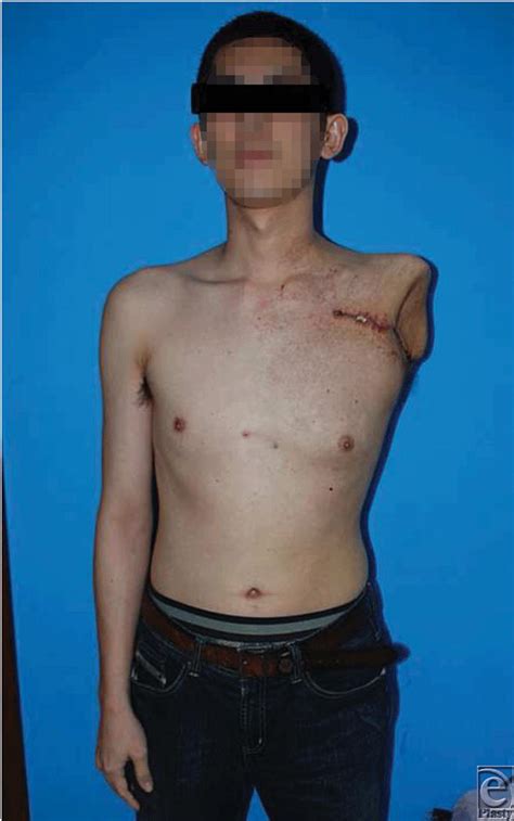 Traumatic Leg Amputation