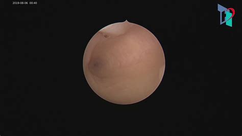 Polypoidal Endometrium Dr Anupama Sethi Arora Youtube