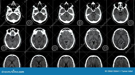 Brain Ct Scan Showing Brainstem Cavernoma Right Centrum Semiovale Developmental Venous Anomaly