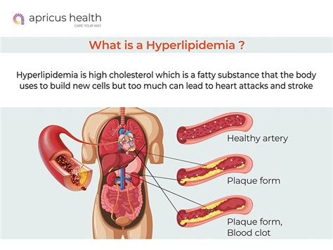 Understanding Hyperlipidemia Causes Symptoms And Treatment Options