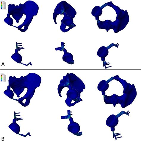 Modular Hemipelvic Endoprosthesis With A Sacral Hook A Finite Element