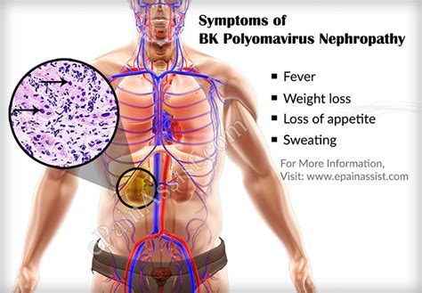 Bk Polyomavirus Nephropathy Causes Symptoms Diagnosis Treatment