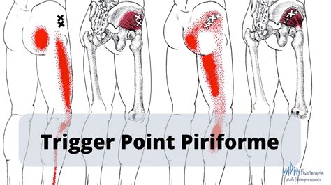 Piriformis Trigger Point Release