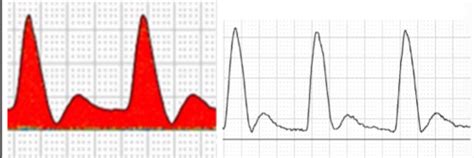 Part 2 Abi Physiologic Arterial Testing Of Lower Extremity Waveforms