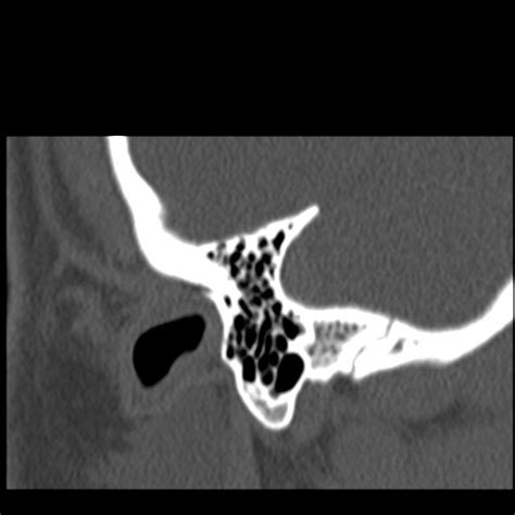 Normal Temporal Bone Ct With Annotated Images Radiopaedia 84293 99584 Lt Poschl Nc Commons