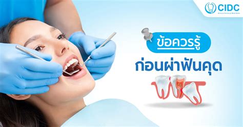 ข้อควรรู้ ก่อนผ่าฟันคุด Cidc เชียงใหม่ เดนทัล