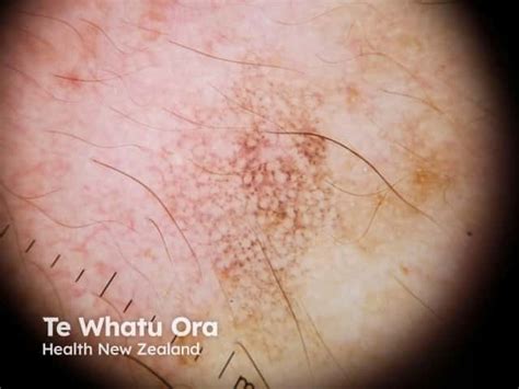 Actinic Keratosis Dermoscopy Images