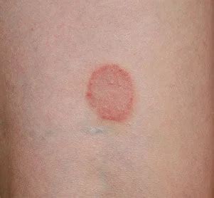 Natural Treatment For Rashes Dermatologist Los Angeles