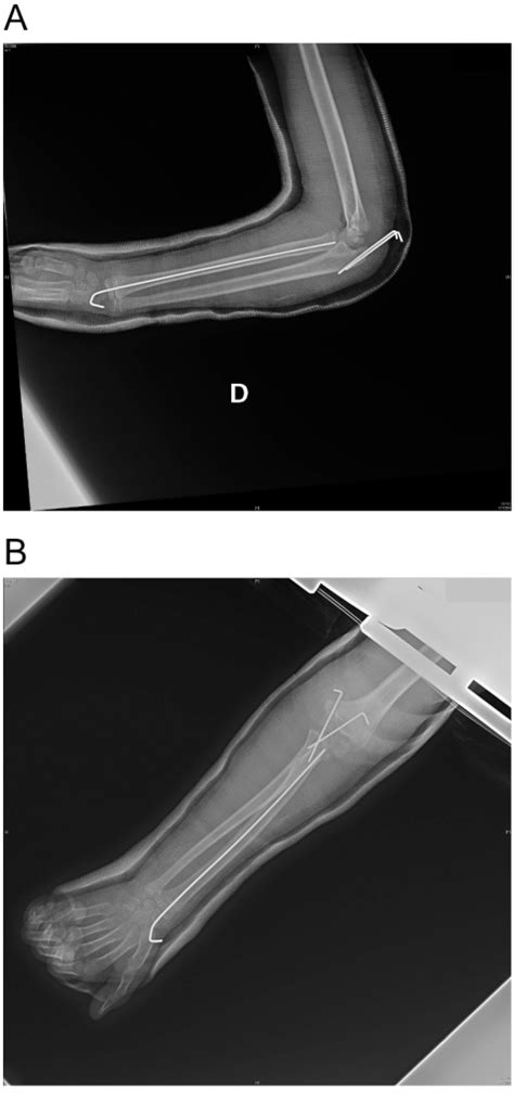 Figure 1 From Pediatric Trans Olecranon Fracture Dislocation Of The Elbow Associated With