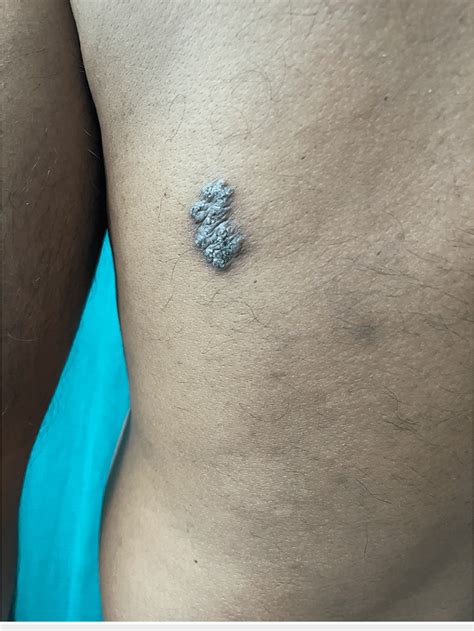 Figure 2 From Multifocal Lupus Vulgaris A Rare Presentation Semantic Scholar