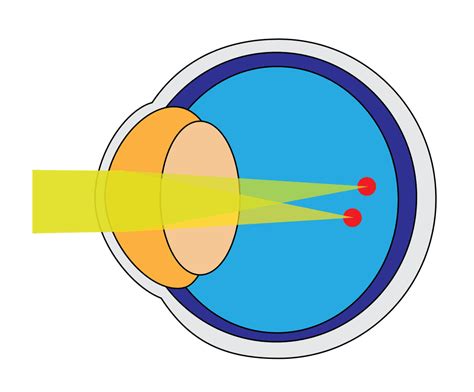 Learning About Astigmatism Adam Hart M D Ophthalmologist