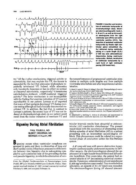 Pdf Bigeminy During Atrial Fibrillation Dokumen Tips