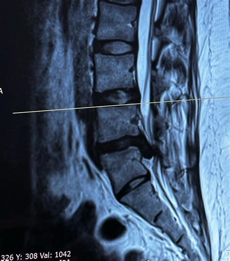 Injection Incoming R Sciatica