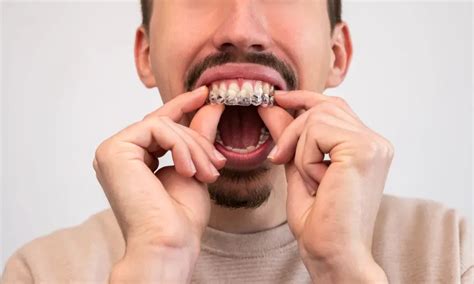 Invisalign Tracking What It Means And Why It Matters Cosmetic