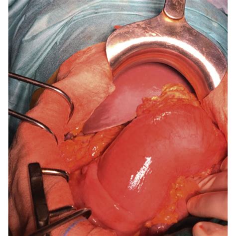 Operative Image Showing Colocolic Intussusception Download
