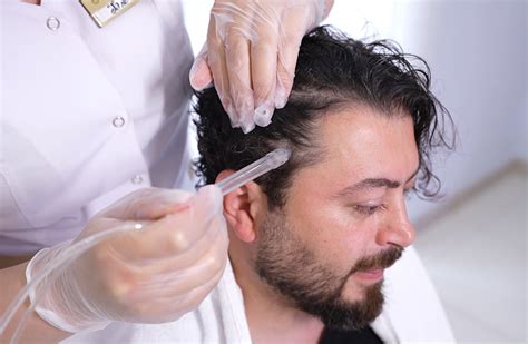 What Is Seborrhea Causes Symptoms And Effective Treatment Empire By