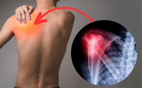 Shoulder Joint Pain Comfort Feet Podiatry Group