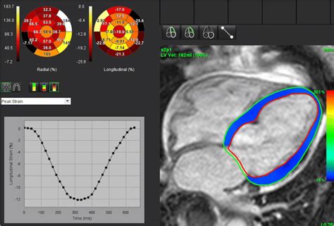 cmr derived gls measured using feature tracking software from two