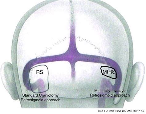 A Minimally Invasive Endoscope Assisted Retrosigmoid Approach For Removal Of Arachnoid Cysts In