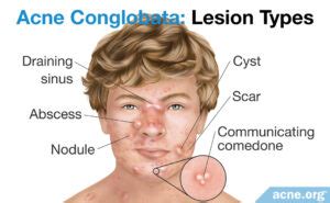 What Is Acne Conglobata Understanding The Condition